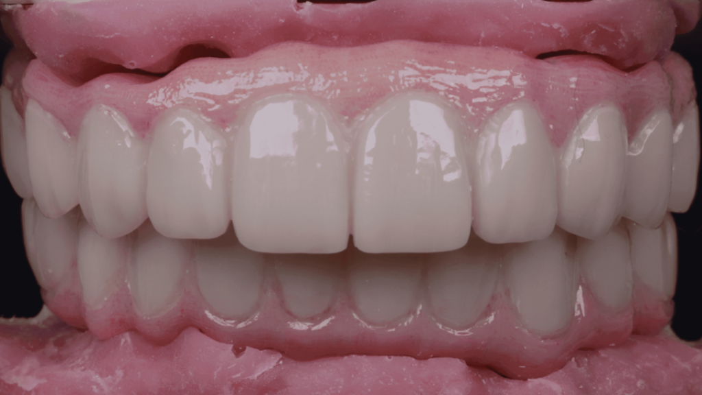 All-on-4 - BFC-Dental